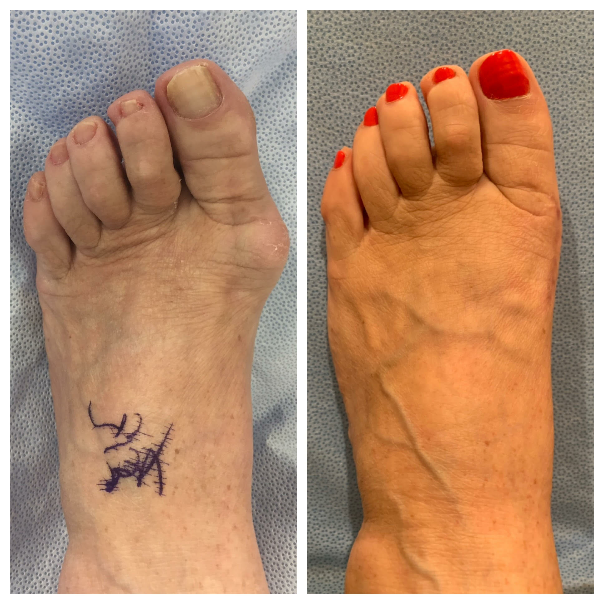 Surgical - 26 Foot & Ankle