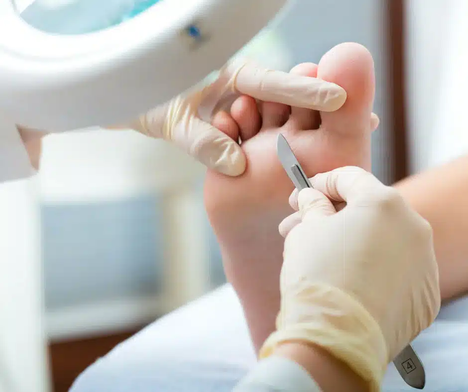 Skin: Calluses and Corns - 26 Foot & Ankle