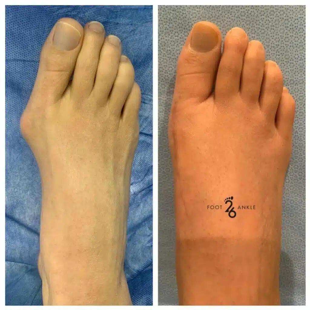 Big Toe Joint: Bunion Repair: Standard - 26 Foot & Ankle