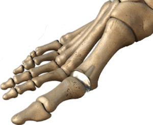 Big Toe Joint: Joint Replacement - 26 Foot & Ankle