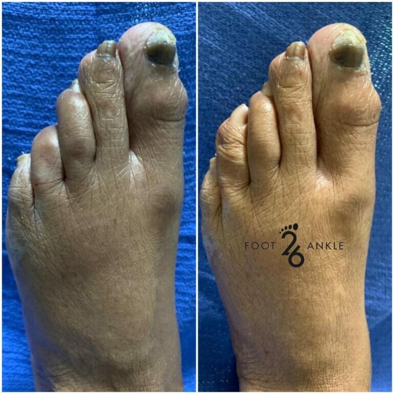 Hammertoe Tendon Release - 26 Foot & Ankle