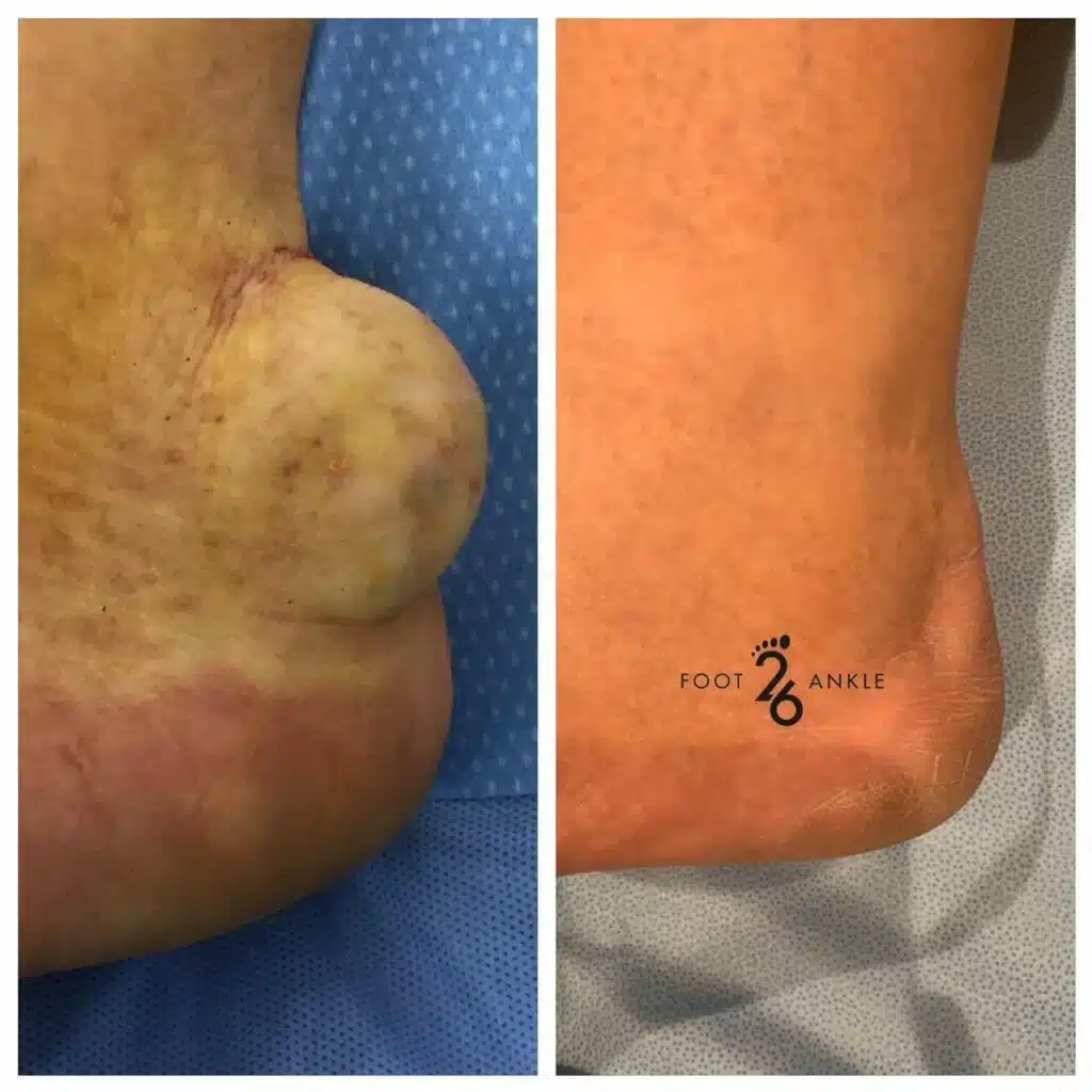 Soft Tissue Masses: Ganglion Cyst - 26 Foot & Ankle
