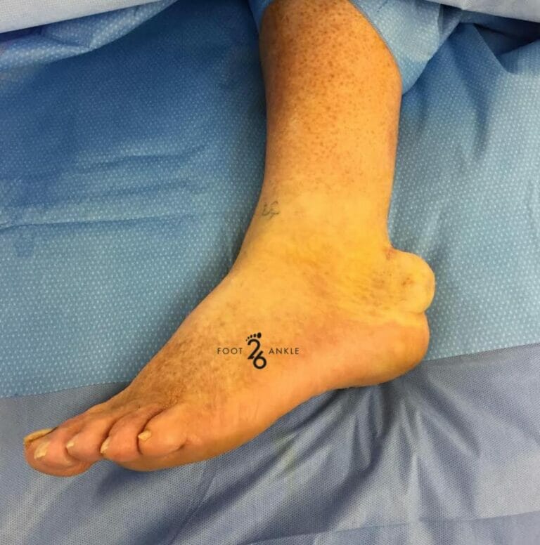 Soft Tissue Masses: Ganglion Cyst - 26 Foot & Ankle