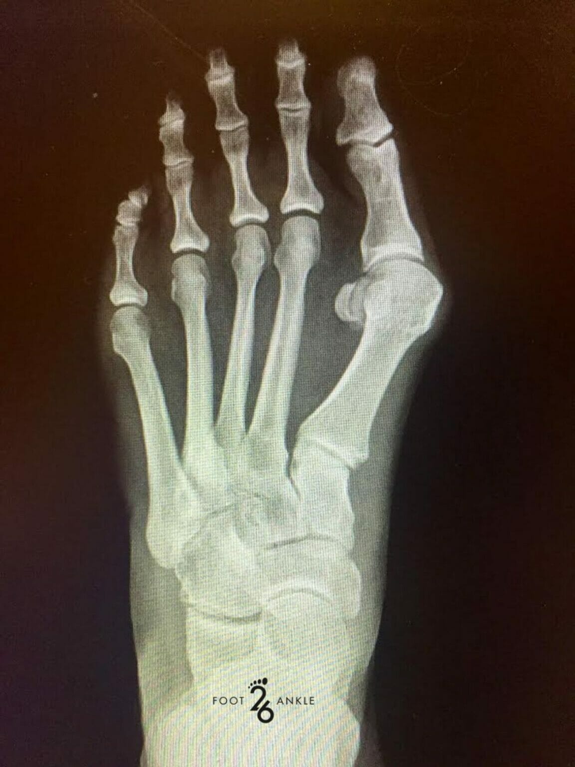 Diagnostic Studies: X-ray (Radiographs) - 26 Foot & Ankle