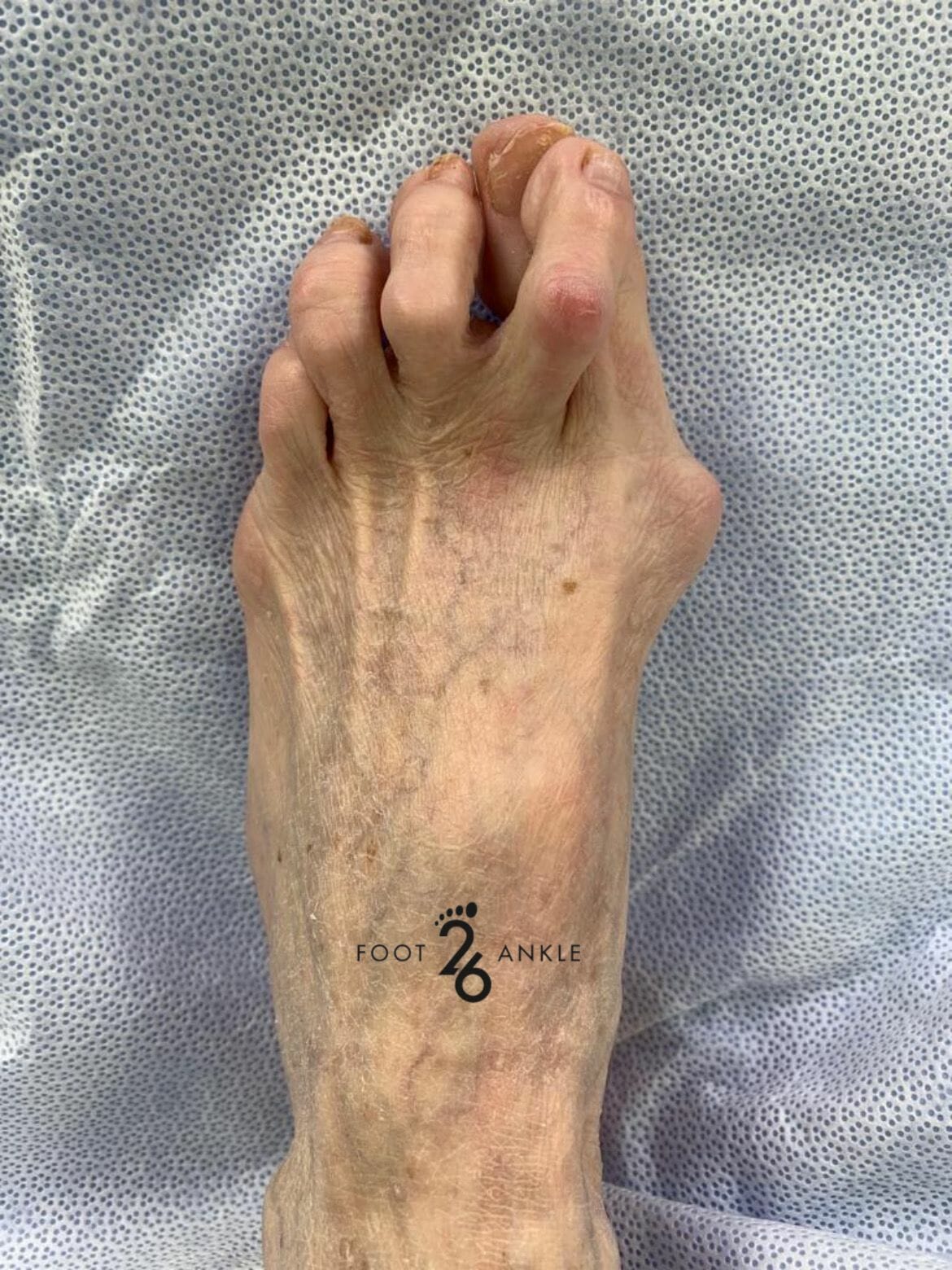 Hammertoe: Severe Crossover Toe - 26 Foot & Ankle