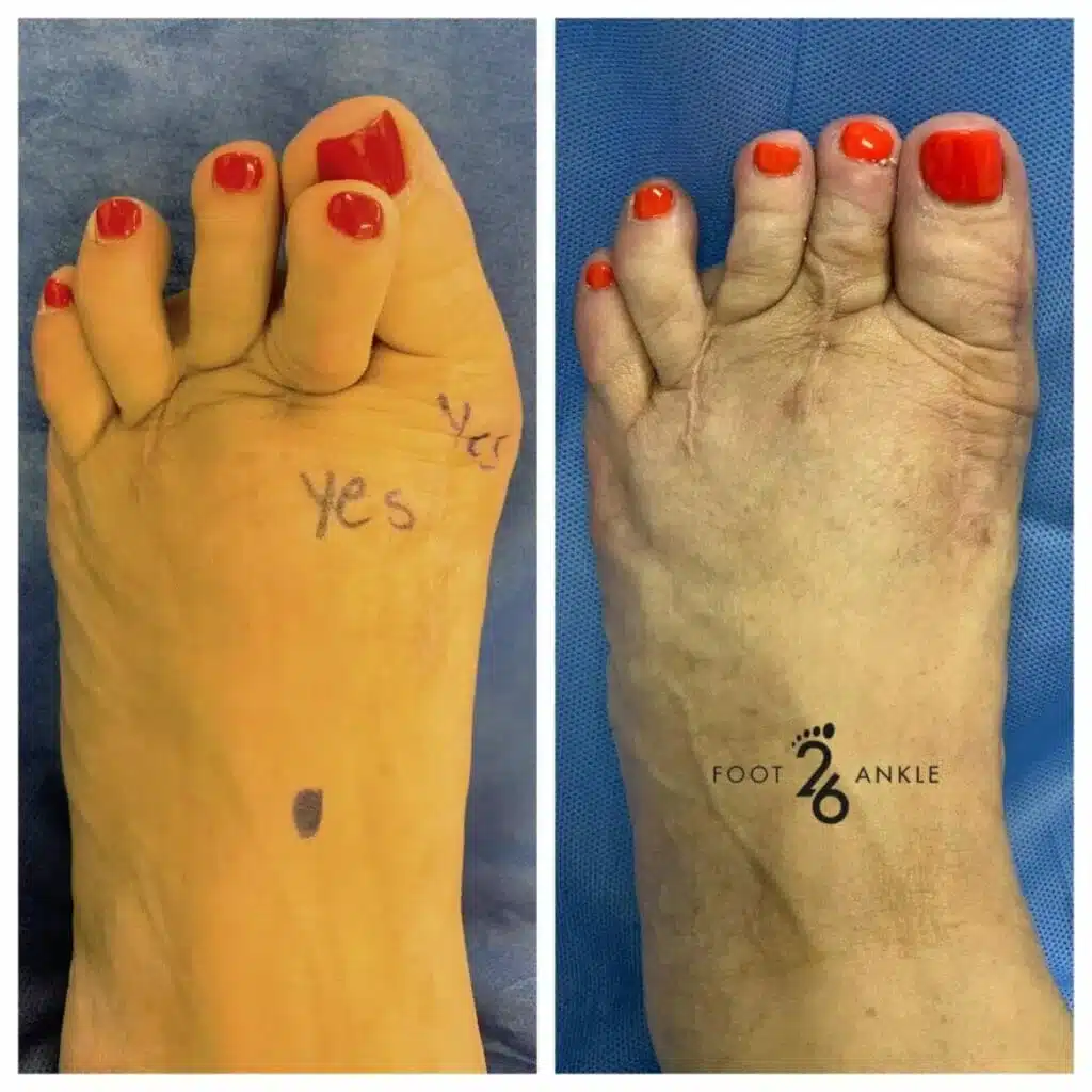 Hammertoe Surgery: Cross Over Toe - 26 Foot & Ankle