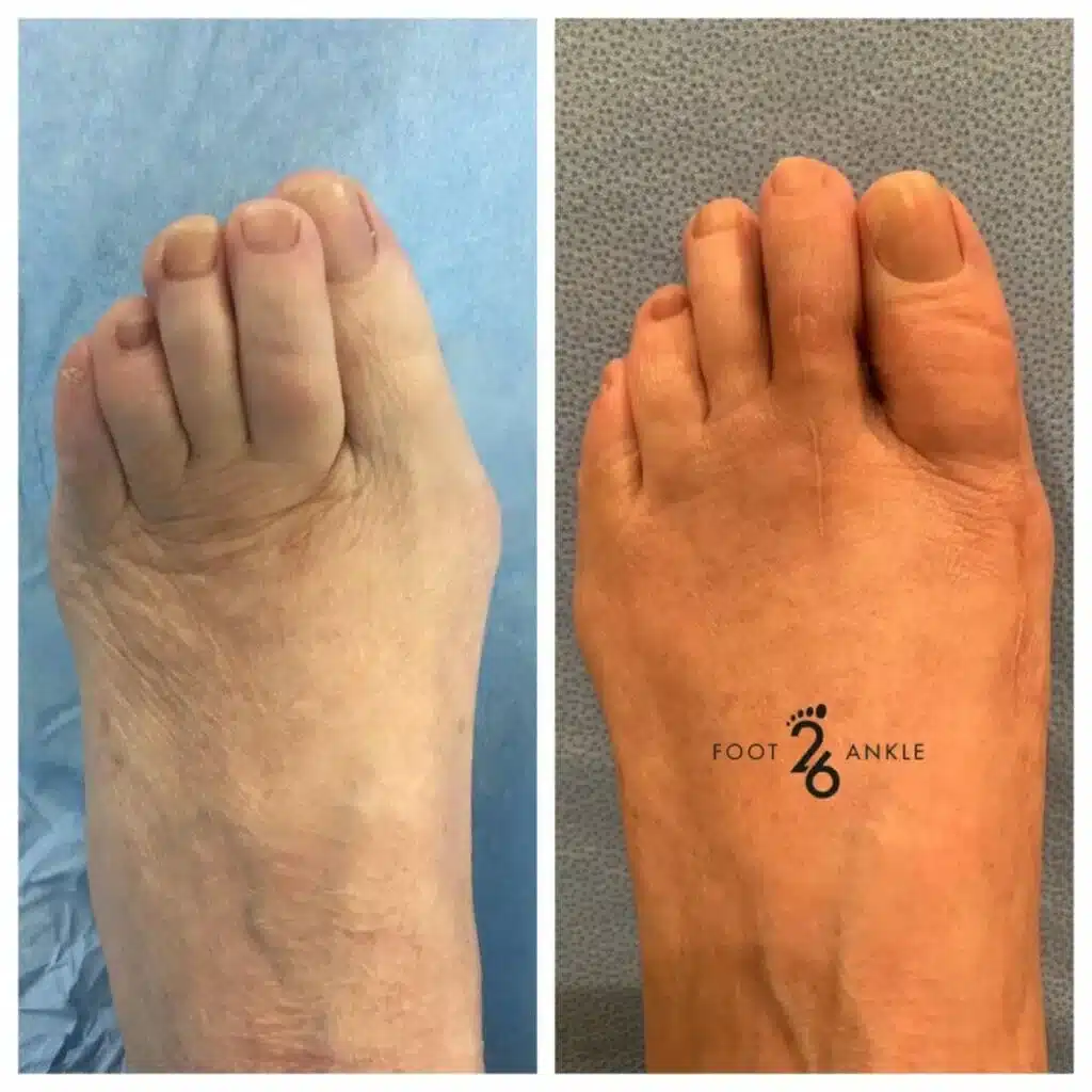 Hammertoe Surgery: Cross Over Toe - 26 Foot & Ankle