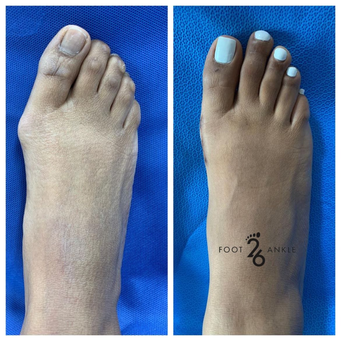 Understanding Traditional Bunion Surgery: A Step-By-Step Guide - 26 ...