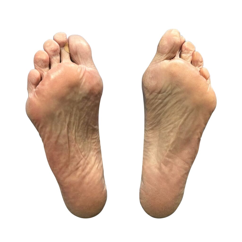 Fat Pad Atrophy - 26 Foot & Ankle