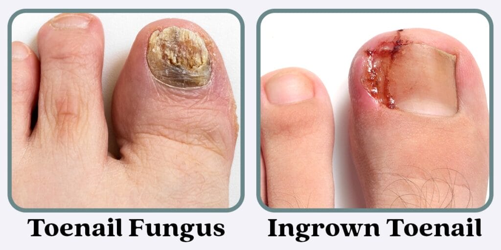 Toenail Fungus vs. Ingrown Toenail - A Podiatrist's Guide - 26 Foot & Ankle
