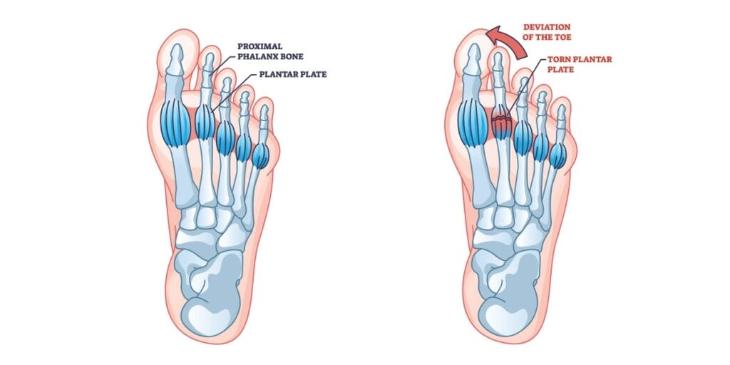 Plantar Plate Injuries: Symptoms, Causes, and Treatment Options for ...