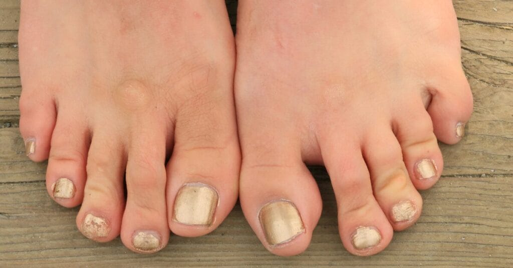 What to Know About Toe Lengthening Surgery - 26 Foot & Ankle